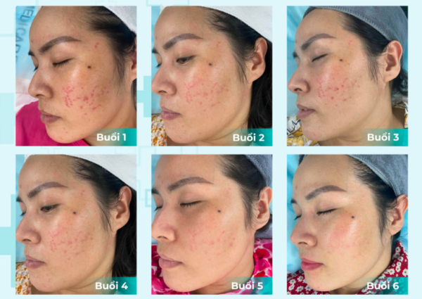 Bio cell peel TCA - MEDICARE CLINIC