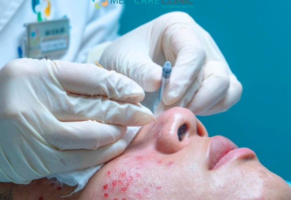 Bio cell peel TCA - MEDICARE CLINIC